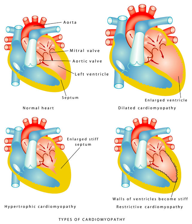 Restrictive Cardiomyopathy